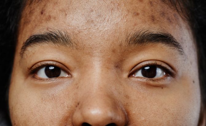 Bahaya Blue Light Bagi Kulit Wajah Begini Cara Mencegahnya