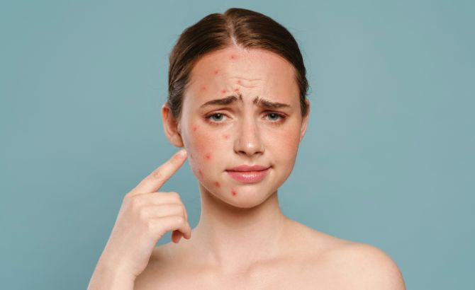 Bingung Wajahmu Purging atau Breakout? Ini Dia Perbedaannya!